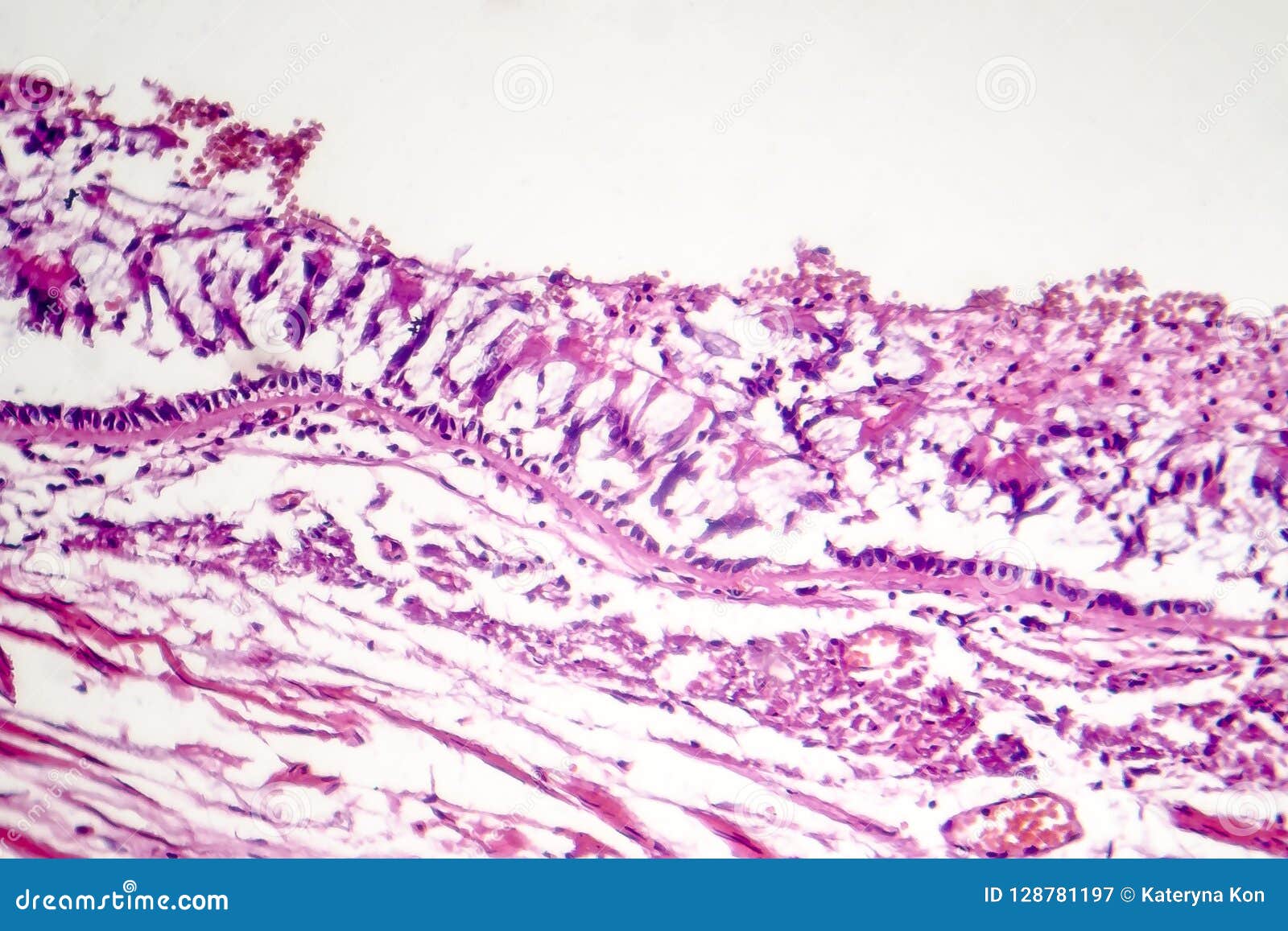 Chronic Bronchitis Under Microscope Stock Image - Image of cell ...