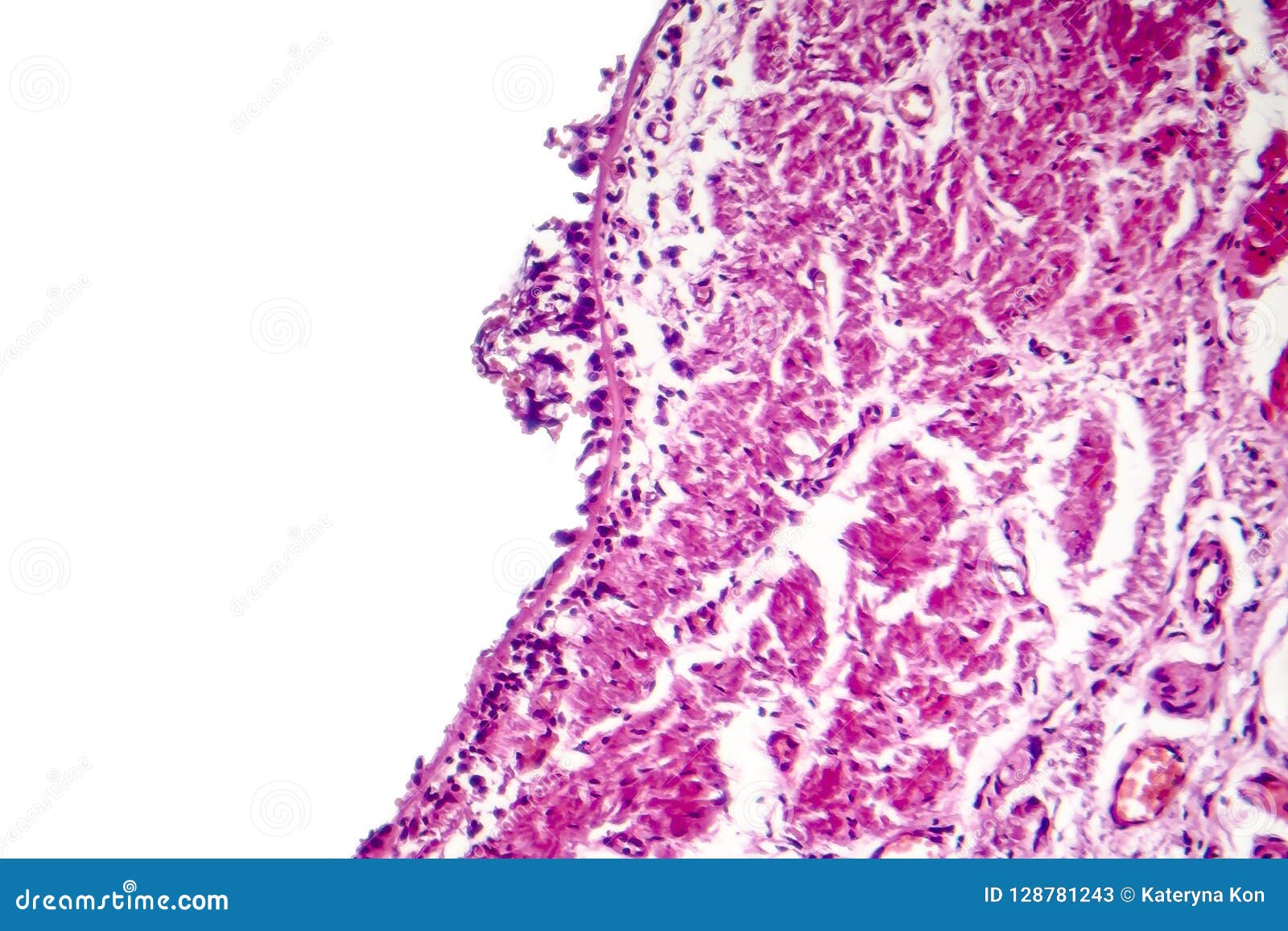 Chronic Bronchitis Under Microscope Stock Image - Image of medical ...