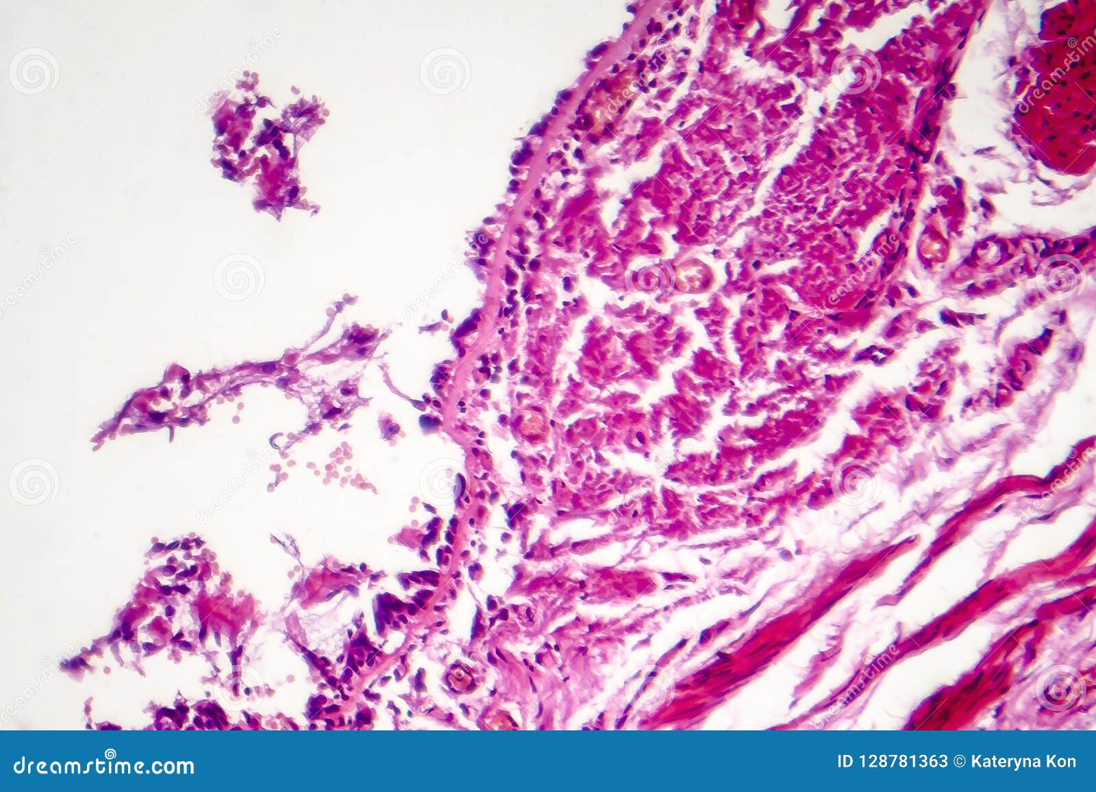 Chronic Bronchitis Under Microscope Stock Image - Image of ...