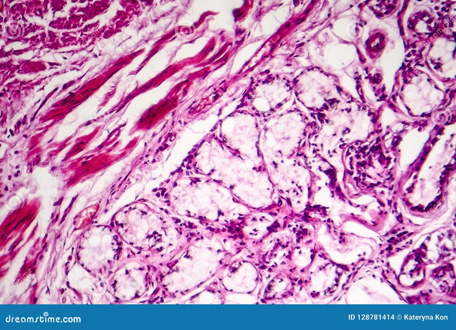 Chronic Bronchitis Under Microscope Stock Photo - Image of tissue ...
