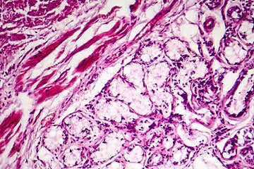 Chronic Bronchitis Under Microscope Stock Photo - Image of tissue ...