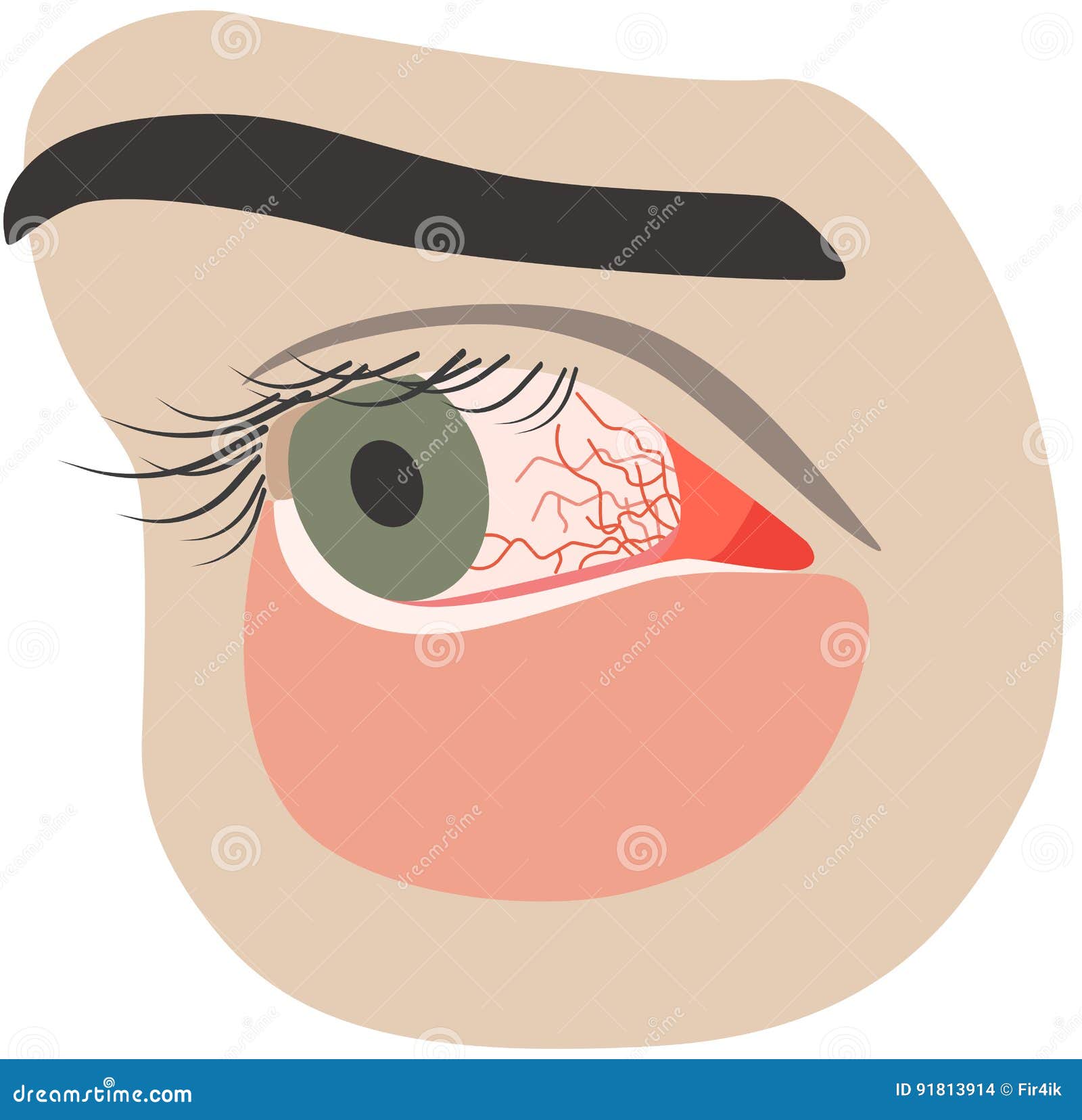 Chronic Conjunctivitis Eye With A Red Iris Vector Illustration ...
