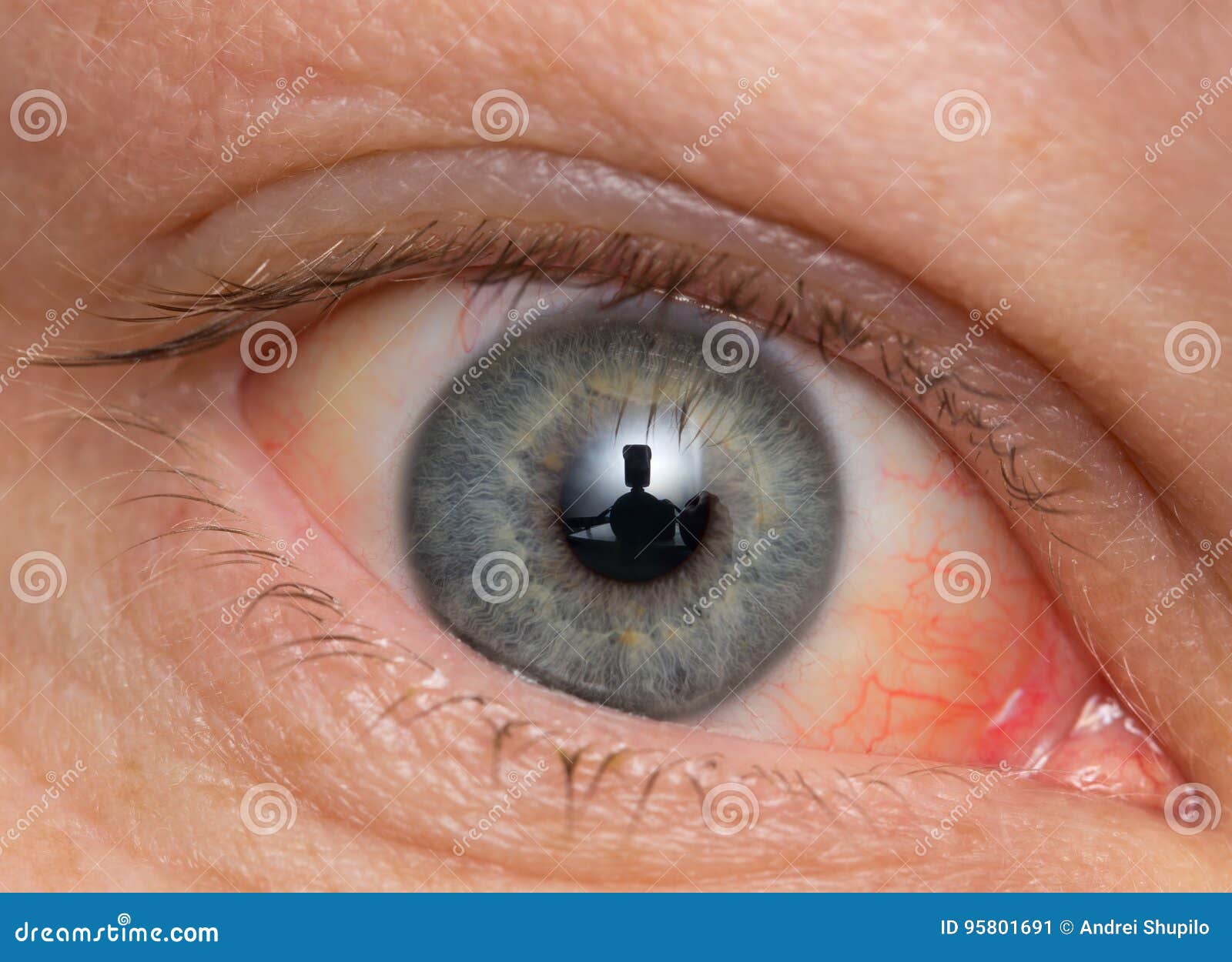 Chronic Conjunctivitis Eye with a Red Iris and Pus Stock Image - Image ...