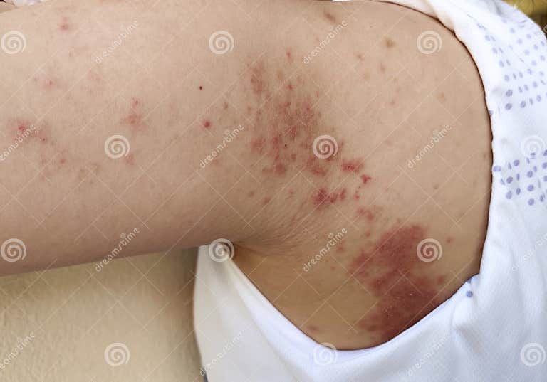 The Chronic Dermatitis Rash Hives Allergy And Peeling Skin Stock