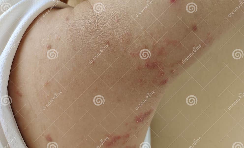 The Chronic Dermatitis Rash Hives Allergy And Peeling Skin Stock