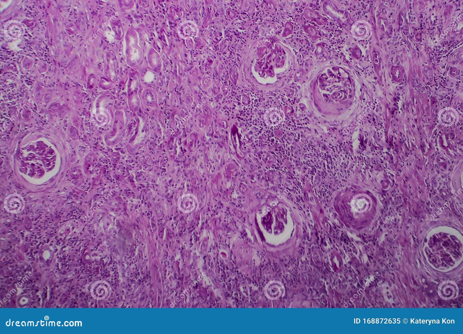Chronic Glomerulonephritis, Light Micrograph Stock Image - Image of ...