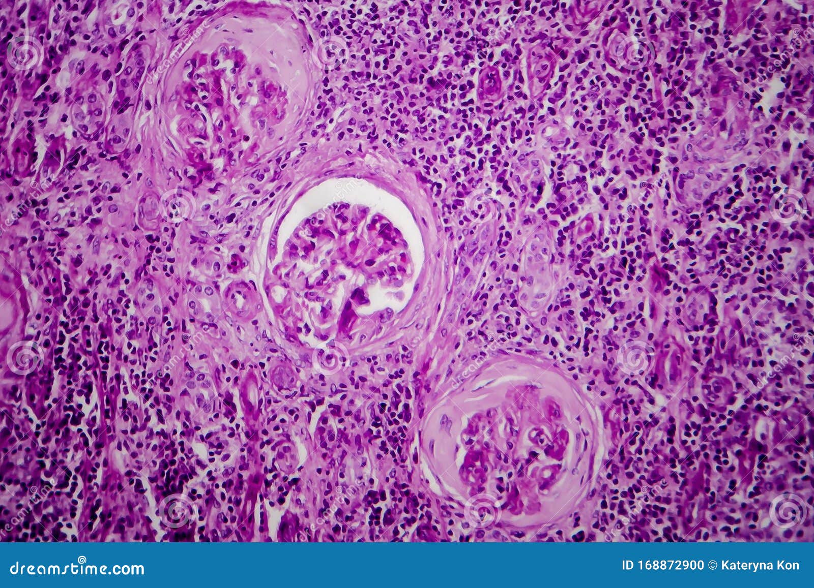 Chronic Glomerulonephritis, Light Micrograph Stock Photo ...