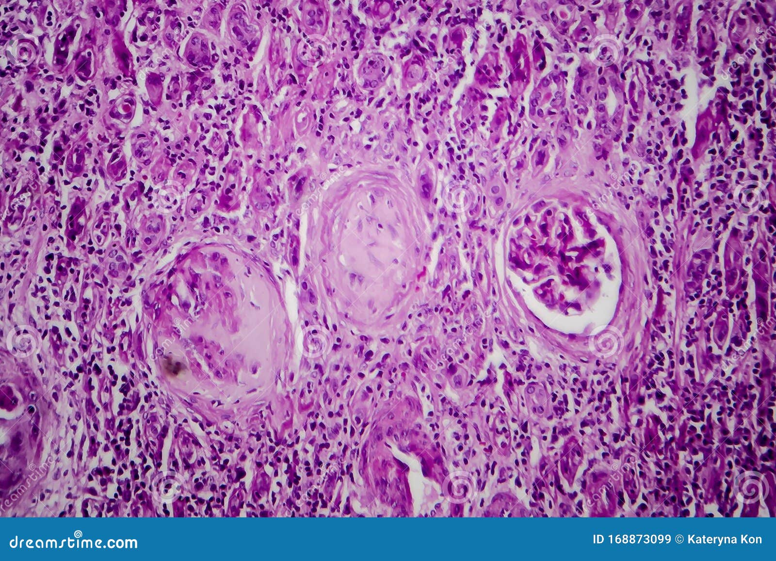 Chronic Glomerulonephritis, Light Micrograph Stock Image - Image of ...