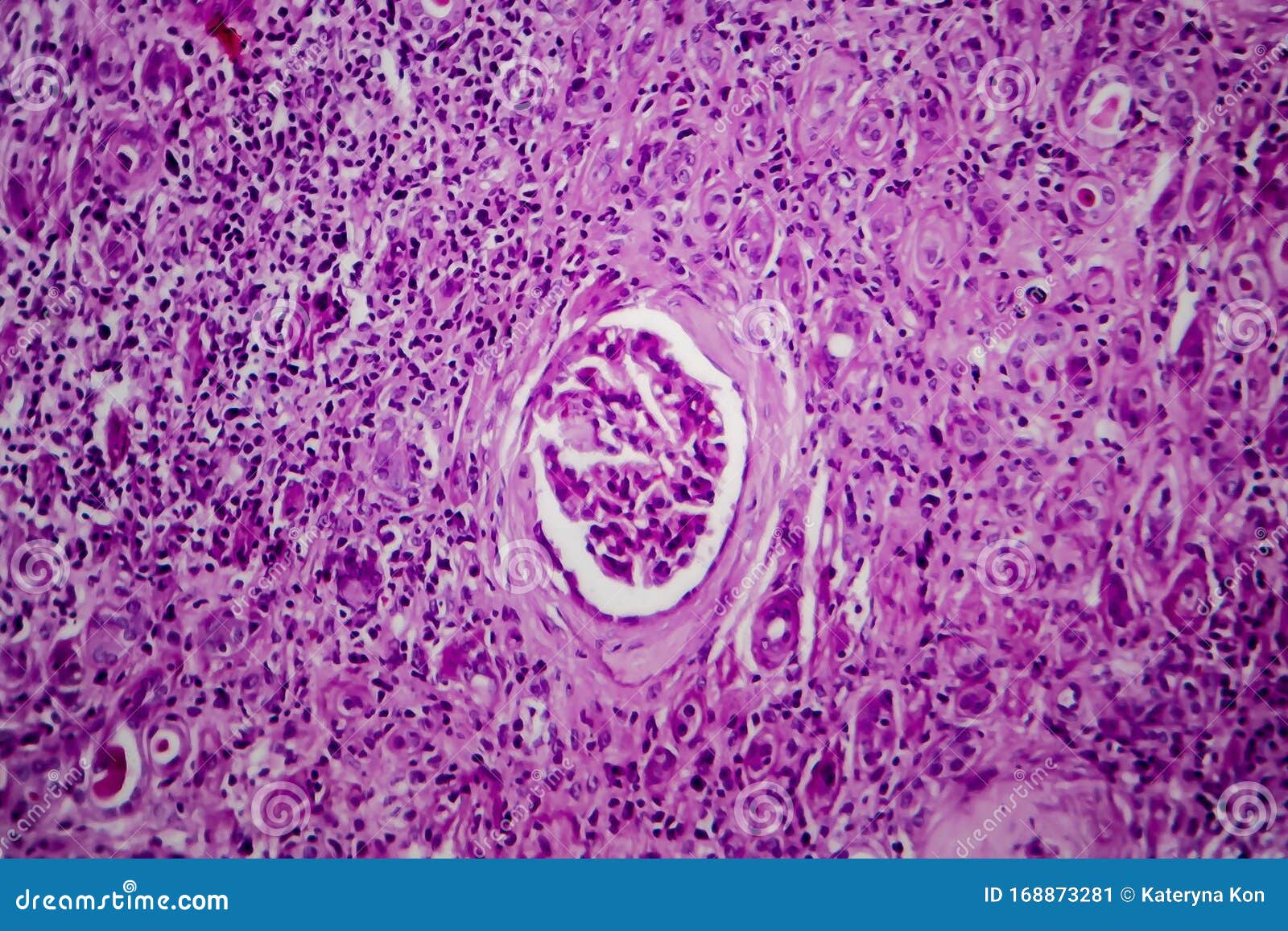 Chronic Glomerulonephritis, Light Micrograph Stock Image - Image of ...