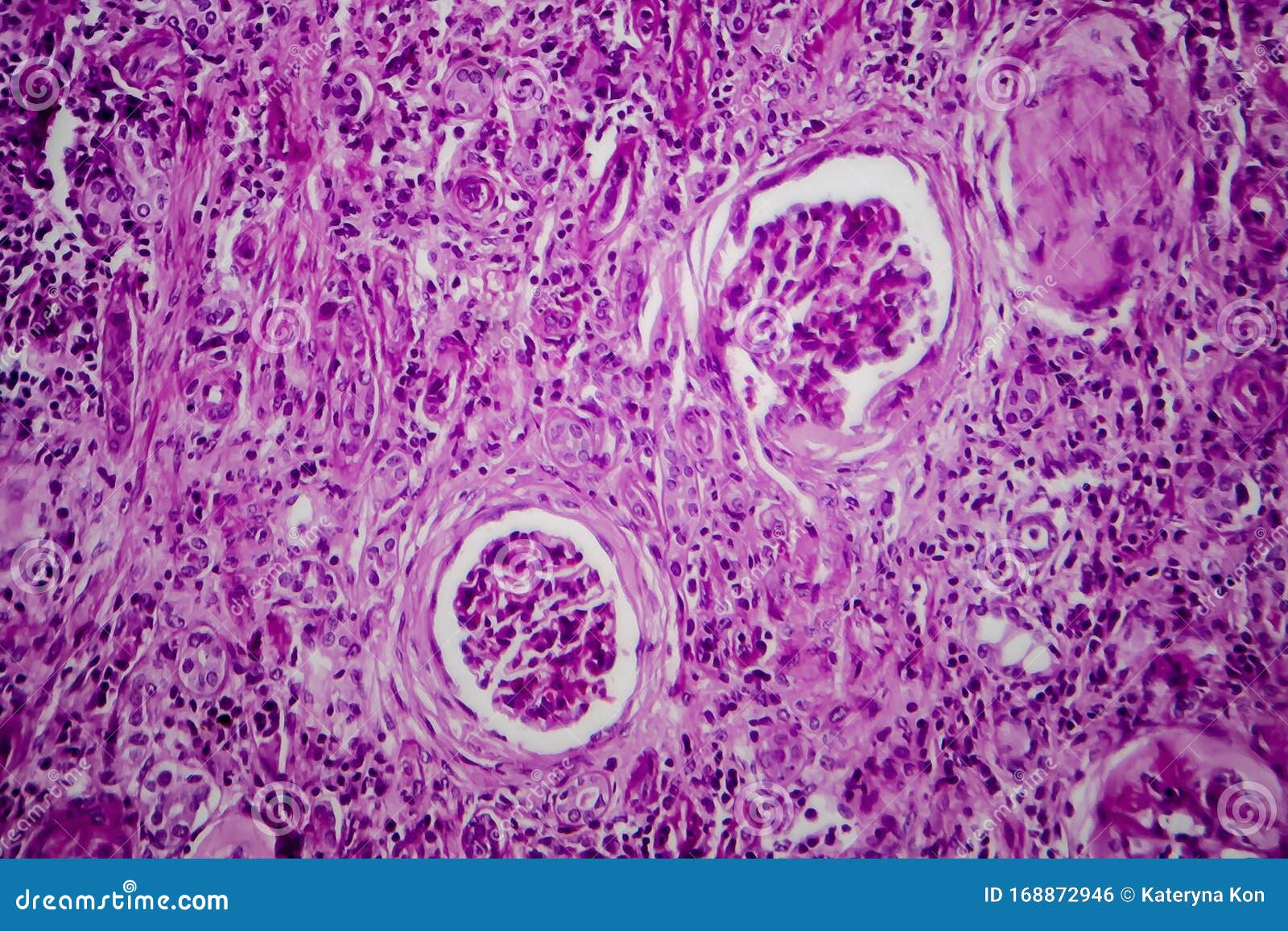 Chronic Glomerulonephritis, Light Micrograph Stock Photo - Image of ...
