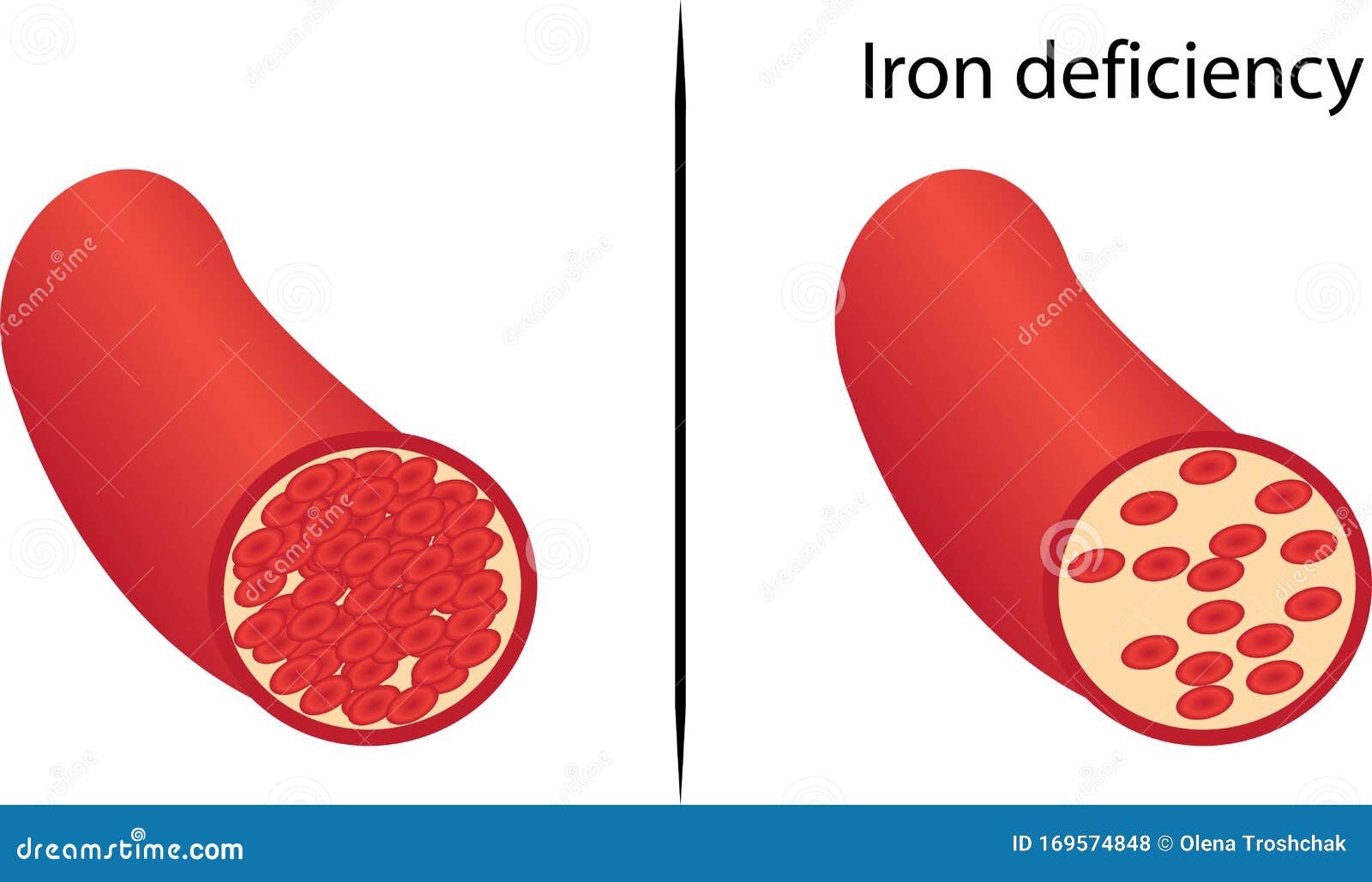 Iron Deficiency Joint Swelling at Andrew York blog