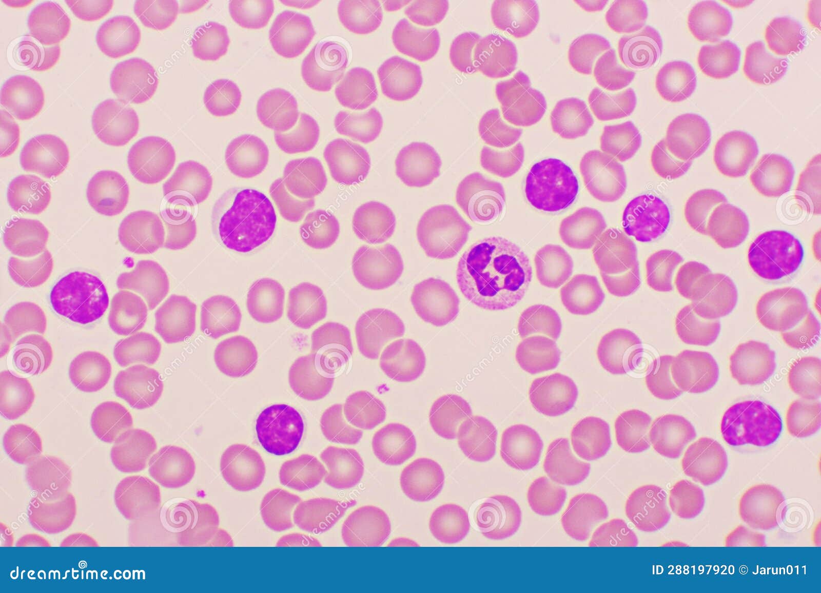 Chronic Lymphocytic Leukemia or CLL Stock Photo - Image of monocyte ...