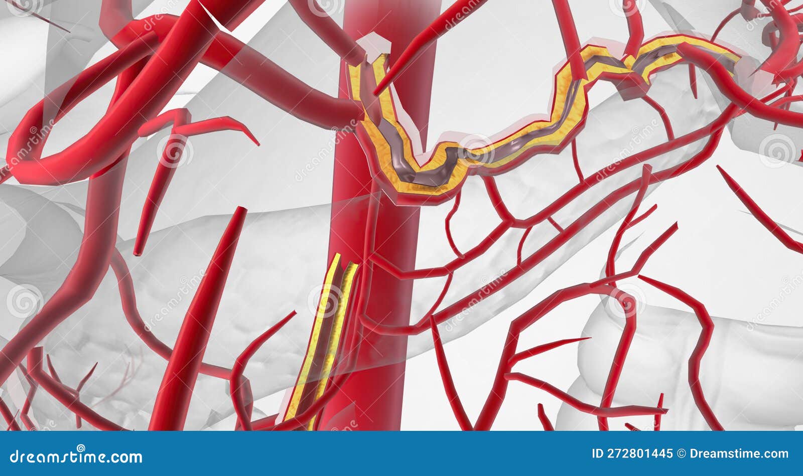Chronic Mesenteric Ischemia is a Decrease in Blood Flow As a Result of ...