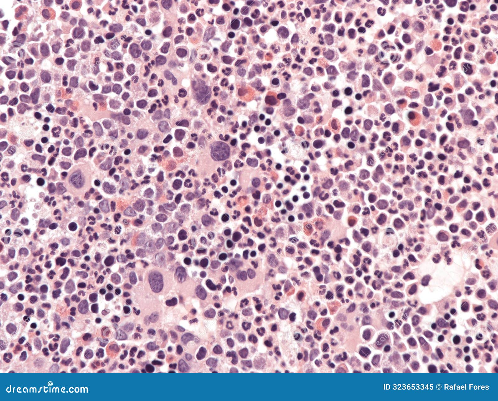 Chronic Myeloid Leukemia, Bone Marrow. Stock Image - Image of ...