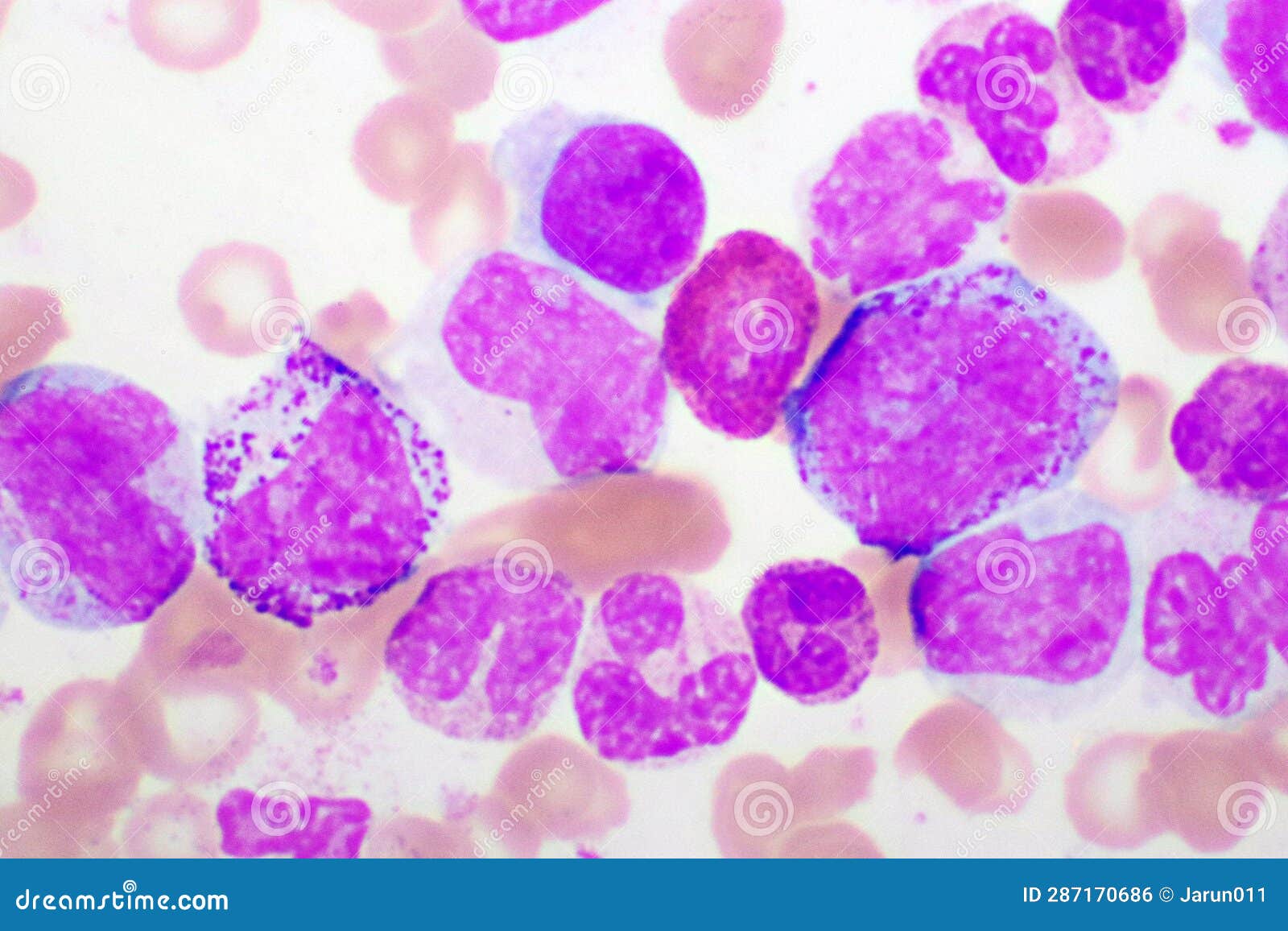 Chronic Myeloid Leukemia Cells Stock Photo - Image of science, blood ...