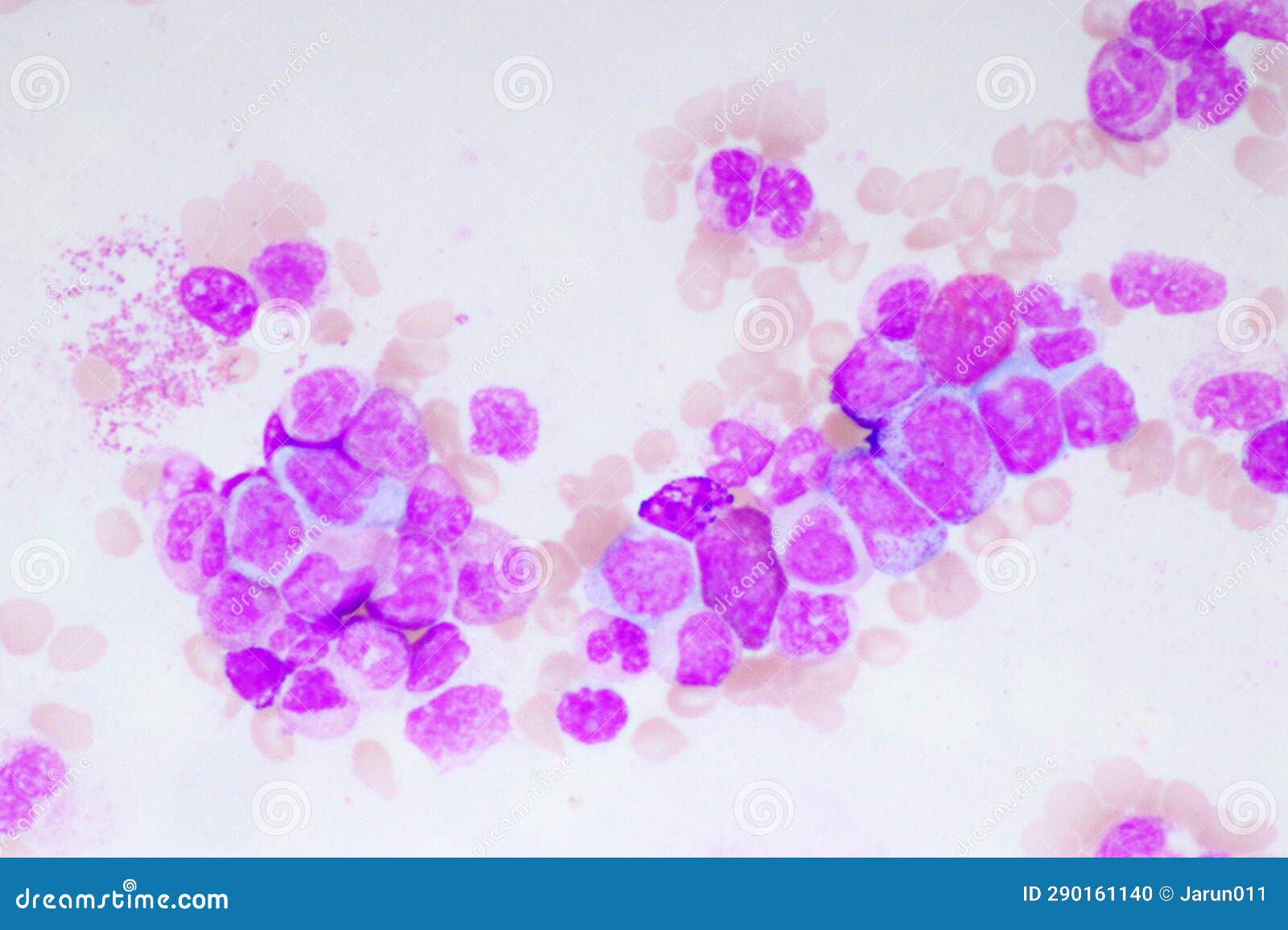 Chronic Myeloid Leukemia Cells Stock Photo - Image of count, slide ...
