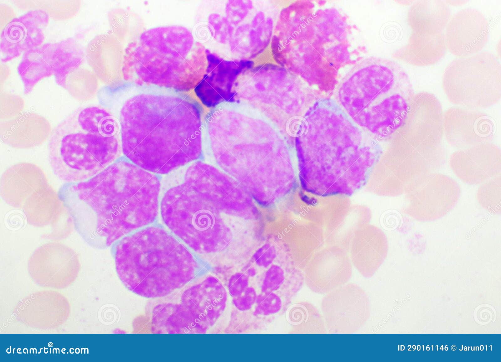 Chronic Myeloid Leukemia Cells Stock Photo - Image of exam, lymphocyte ...