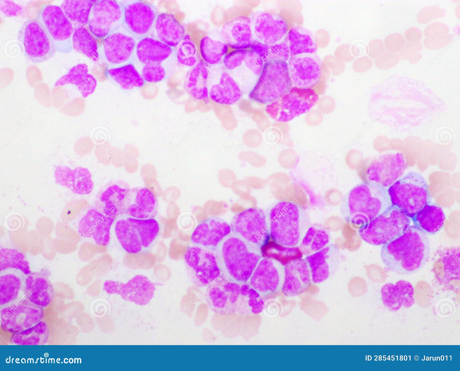 Chronic Myeloid Leukemia Cells or CML Stock Image - Image of white ...