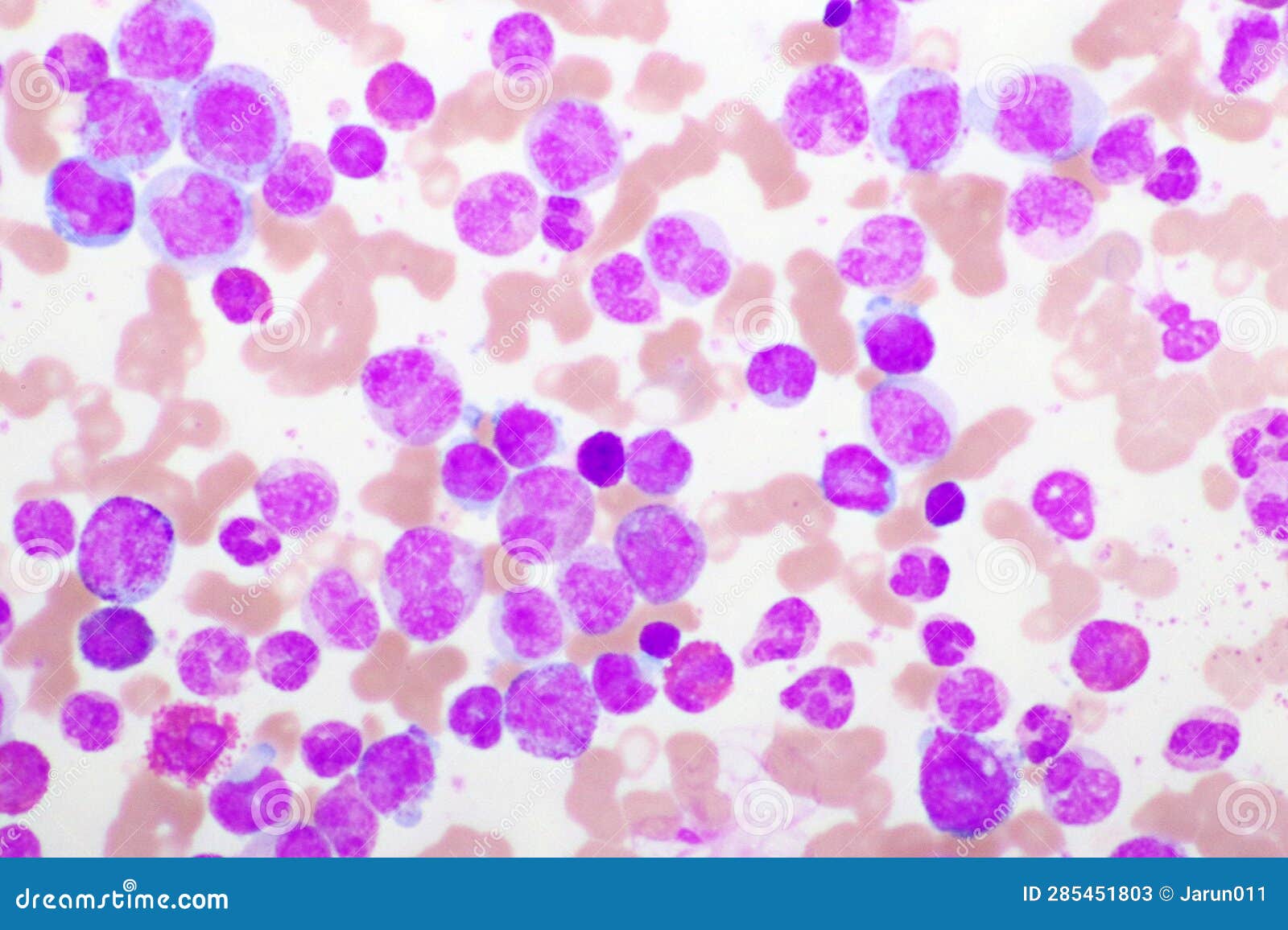 Chronic Myeloid Leukemia Cells or CML Stock Image - Image of slide ...