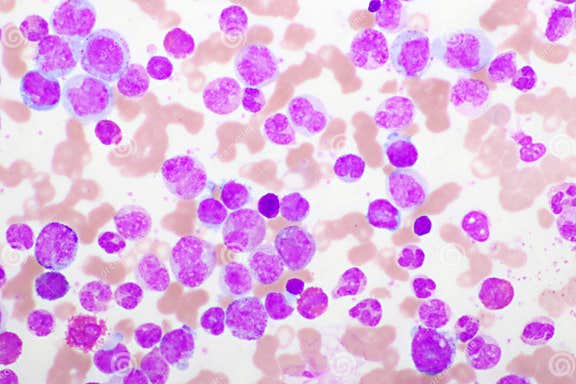 Chronic Myeloid Leukemia Cells or CML Stock Image - Image of slide ...