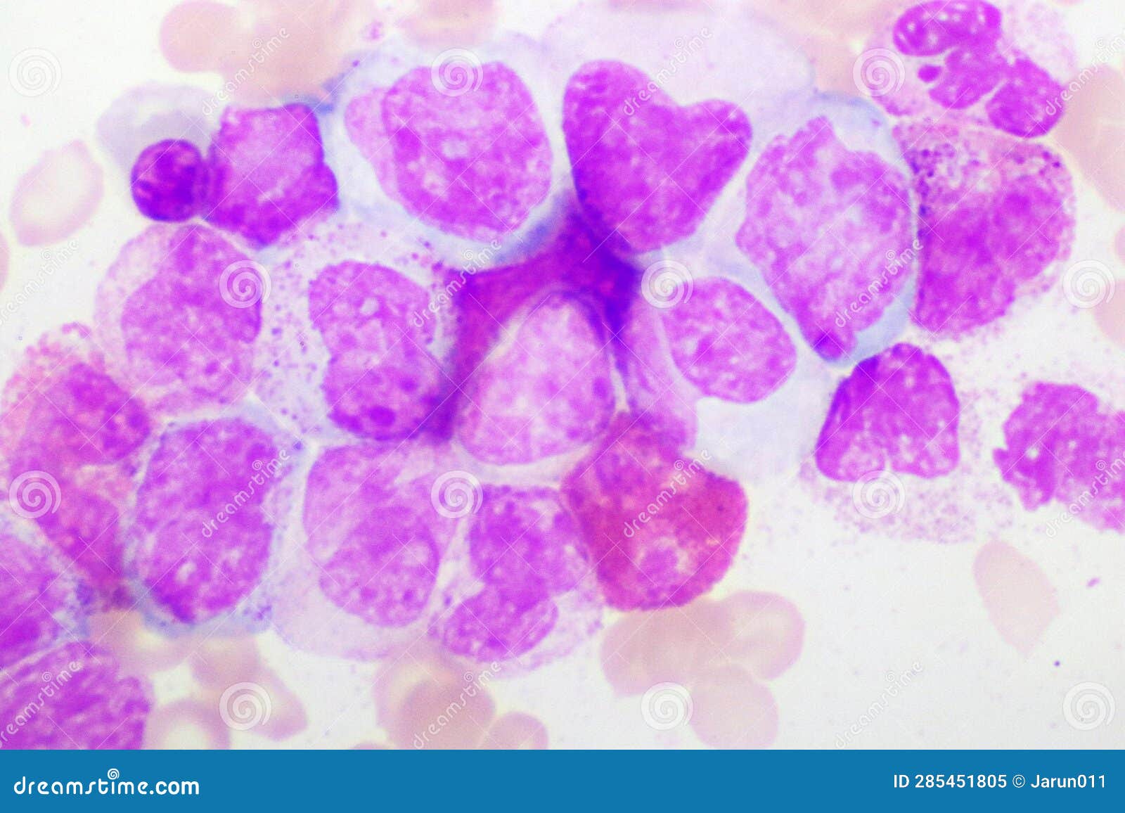 Chronic Myeloid Leukemia Cells or CML Stock Image - Image of care ...