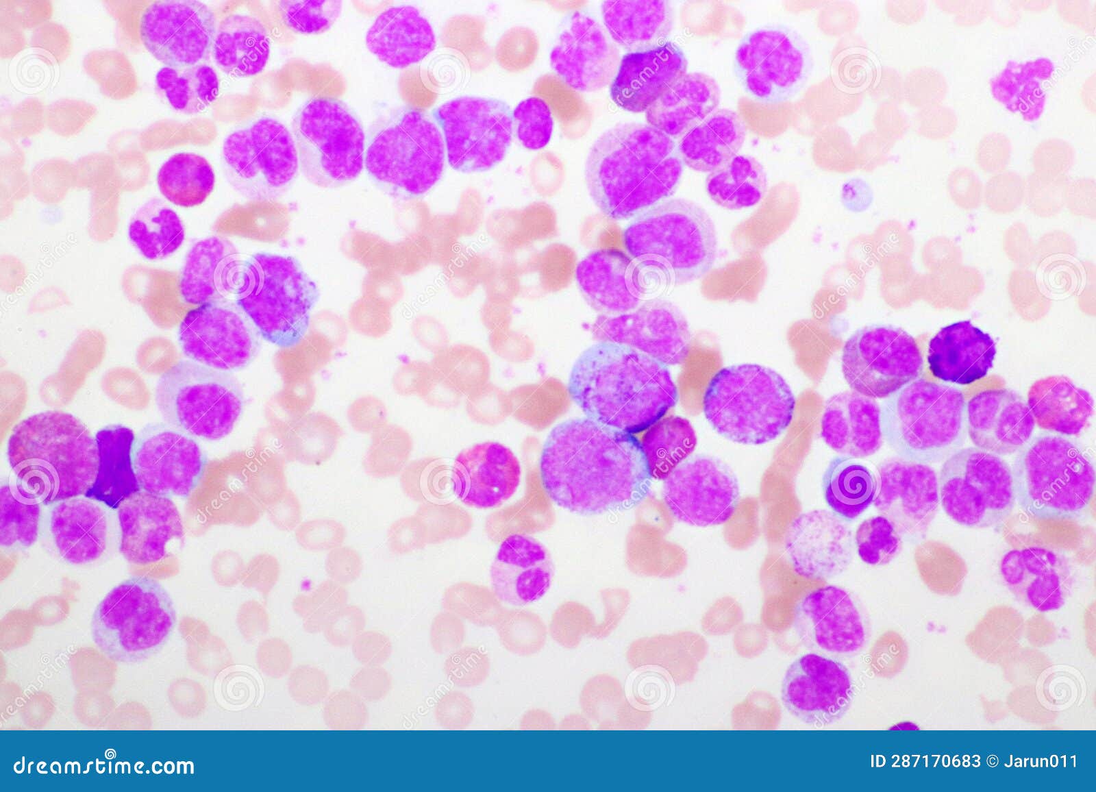 Chronic Myeloid Leukemia Cells Stock Image - Image of white, smear ...
