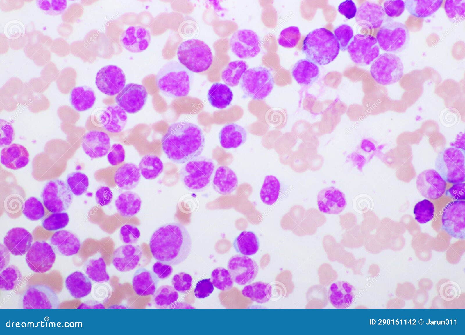 Chronic Myeloid Leukemia Cells Stock Photo - Image of count, science ...