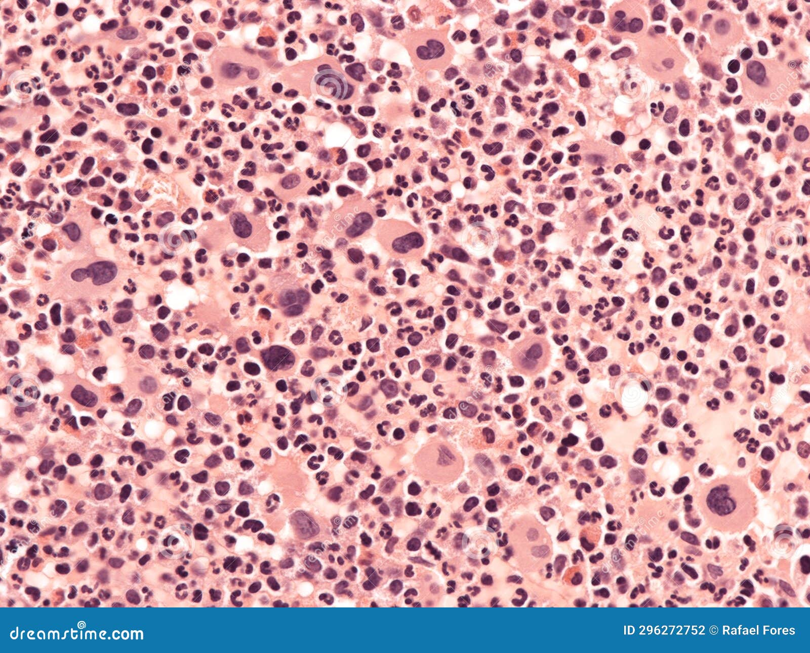 Chronic Myeloid Leukemia, Bone Marrow. Stock Photo - Image of cells ...