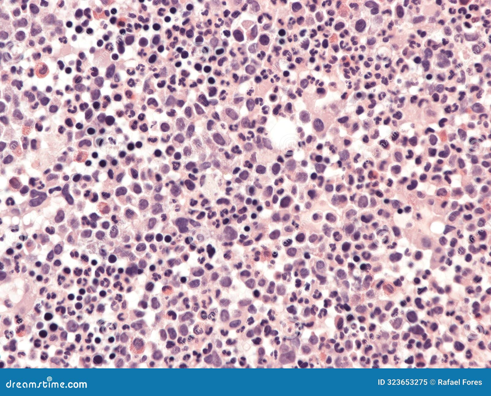 Chronic Myeloid Leukemia, Bone Marrow. Stock Image - Image of ...