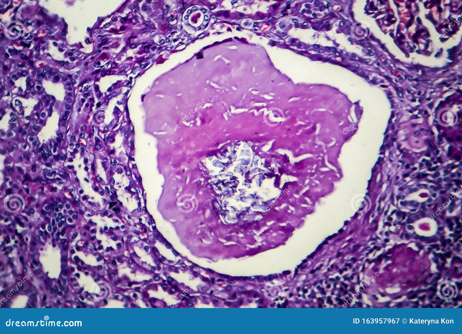Chronic Nephritis, Light Micrograph Stock Image - Image of infection ...