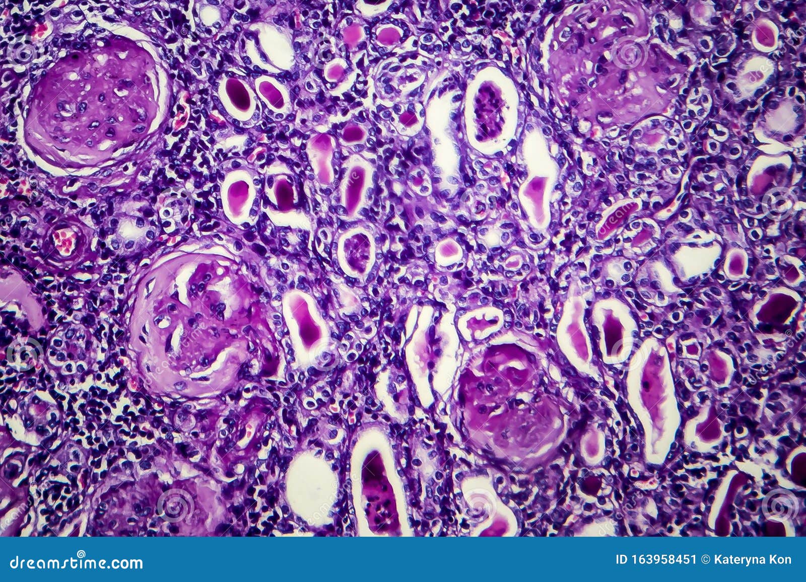 Chronic Nephritis, Light Micrograph Stock Image - Image of tissue ...