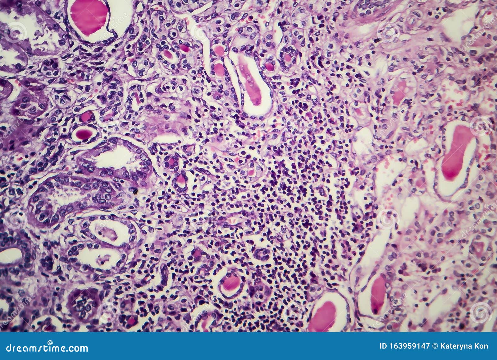 Chronic Nephritis, Light Micrograph Stock Image - Image of medicine ...