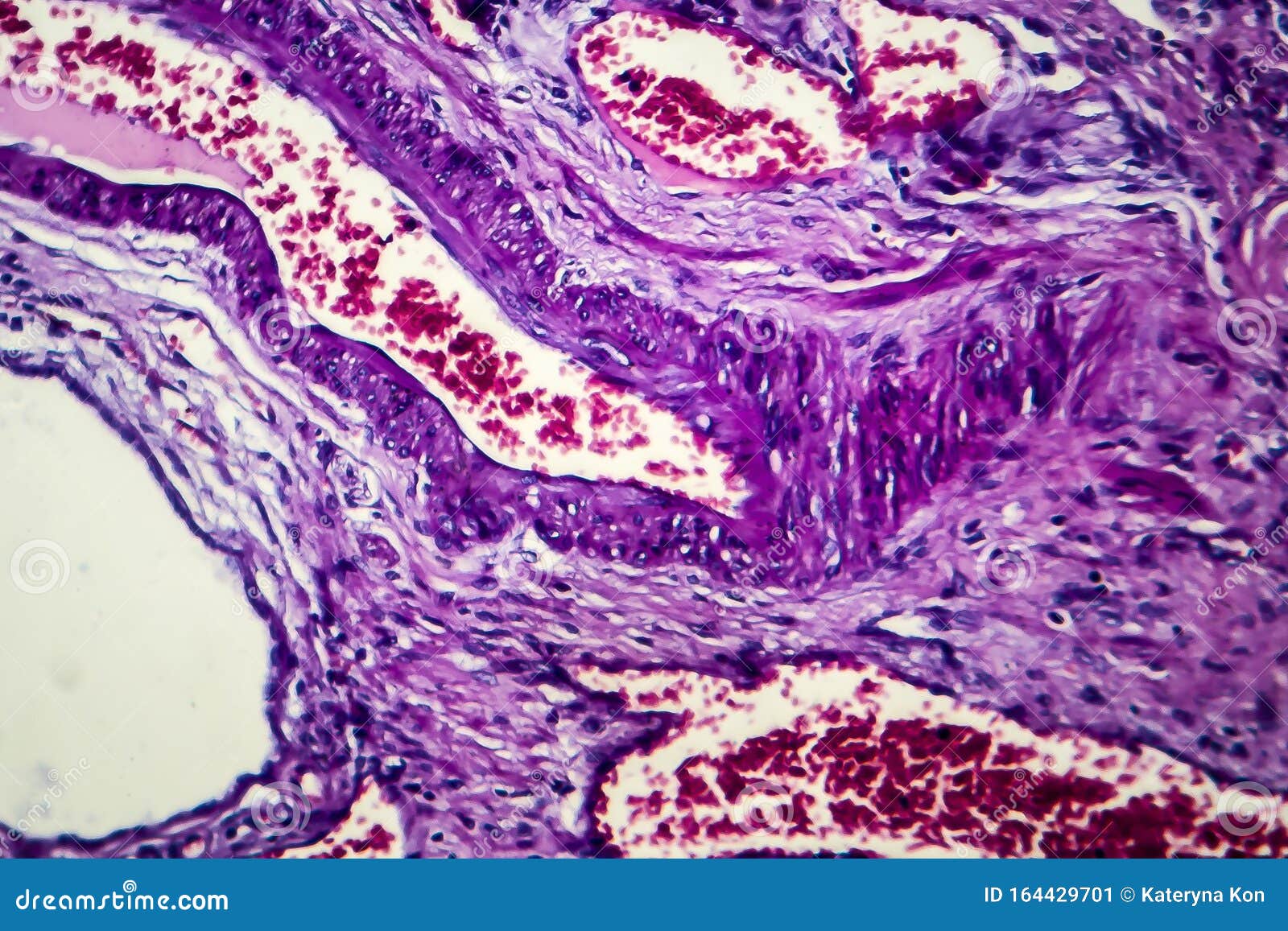 Chronic Nephritis, Light Micrograph Stock Image - Image of urinary ...