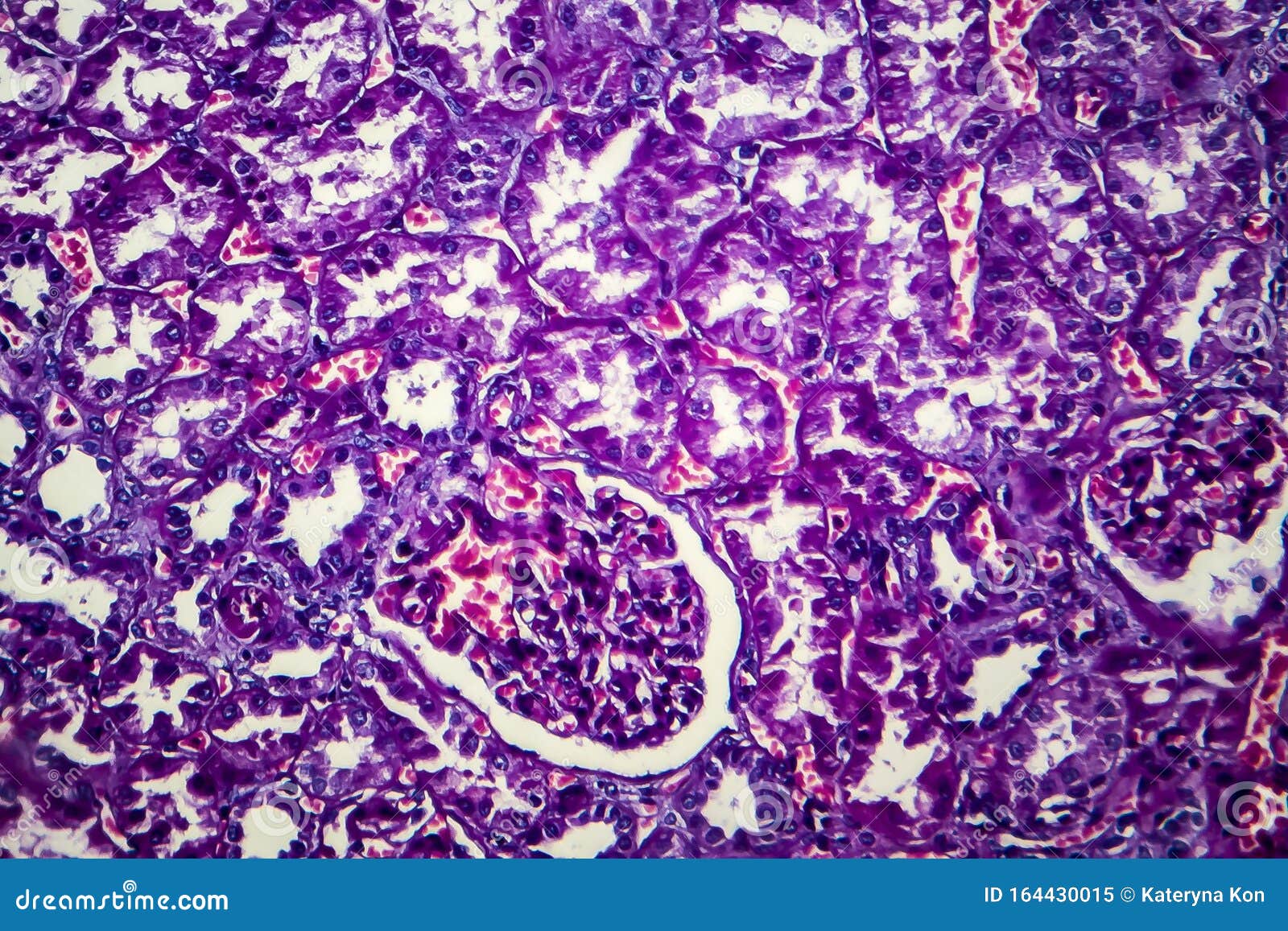 Chronic Nephritis, Light Micrograph Stock Image - Image of ...