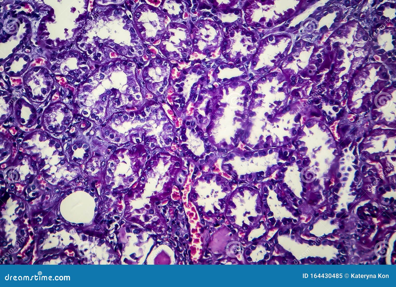 Chronic Nephritis, Light Micrograph Stock Image - Image of renal ...