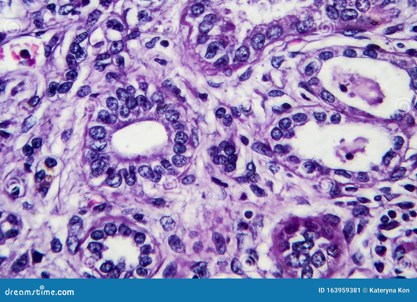 Chronic Nephritis, Light Micrograph Stock Image - Image of ...