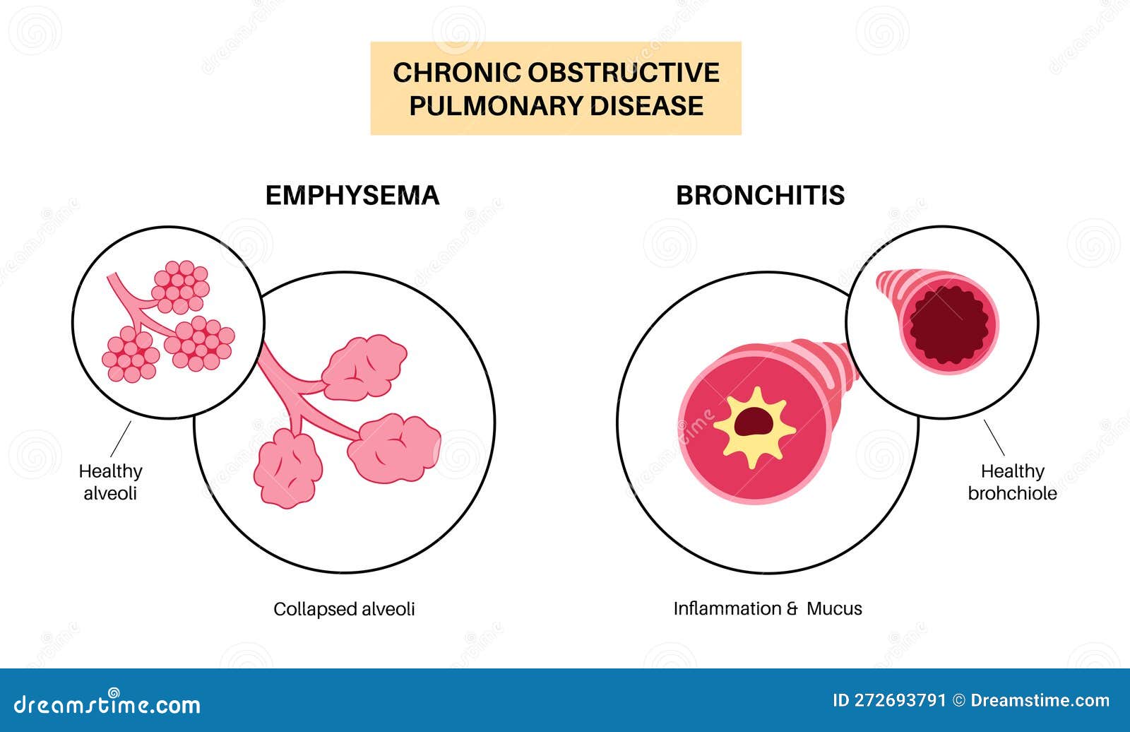 Alveoli Group Showing Chronic Obstructive Pulmonary Disease In Alveoli ...