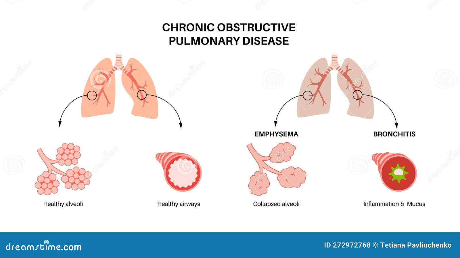 Alveoli Group Showing Chronic Obstructive Pulmonary Disease In Alveoli ...