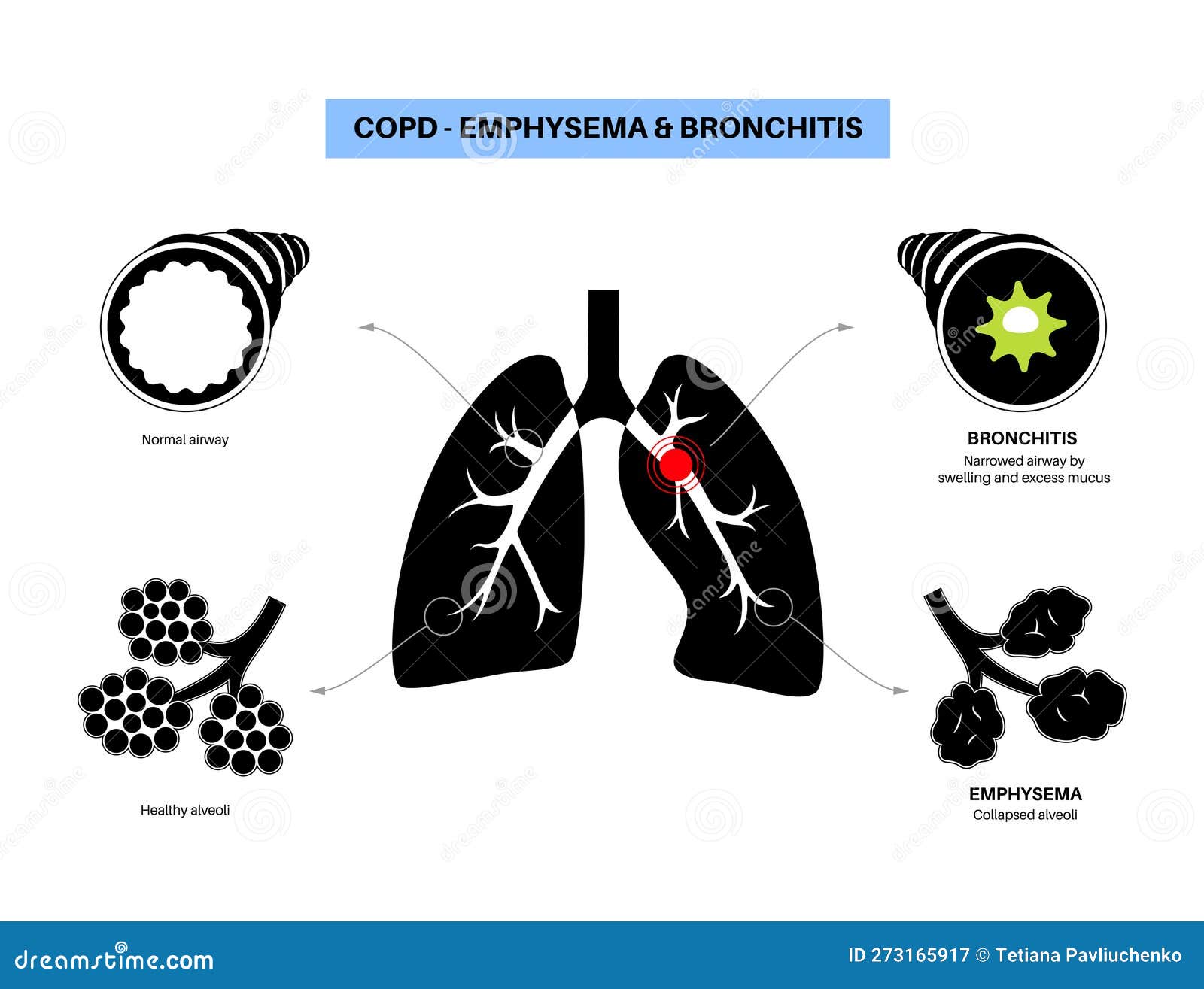 Alveoli Group Showing Chronic Obstructive Pulmonary Disease In Alveoli ...