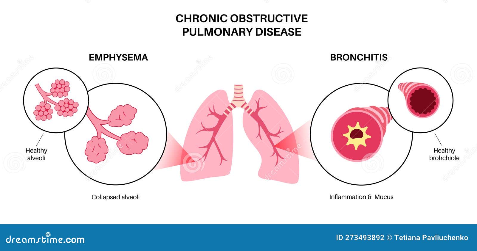 Chronic Obstructive Pulmonary Disease Stock Vector - Illustration of ...