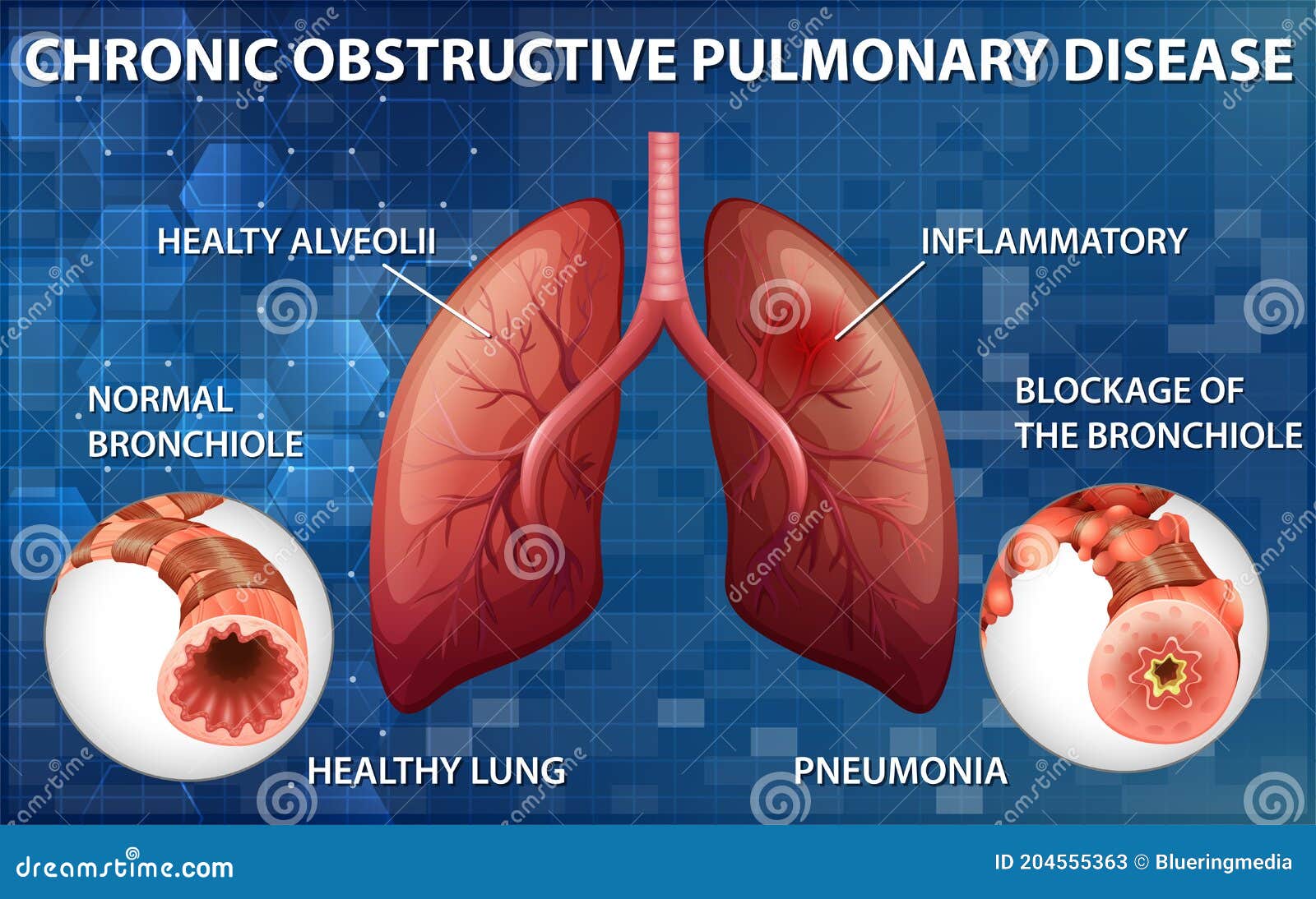 Chronic Obstructive Pulmonary Disease With Lungs Stock Image ...