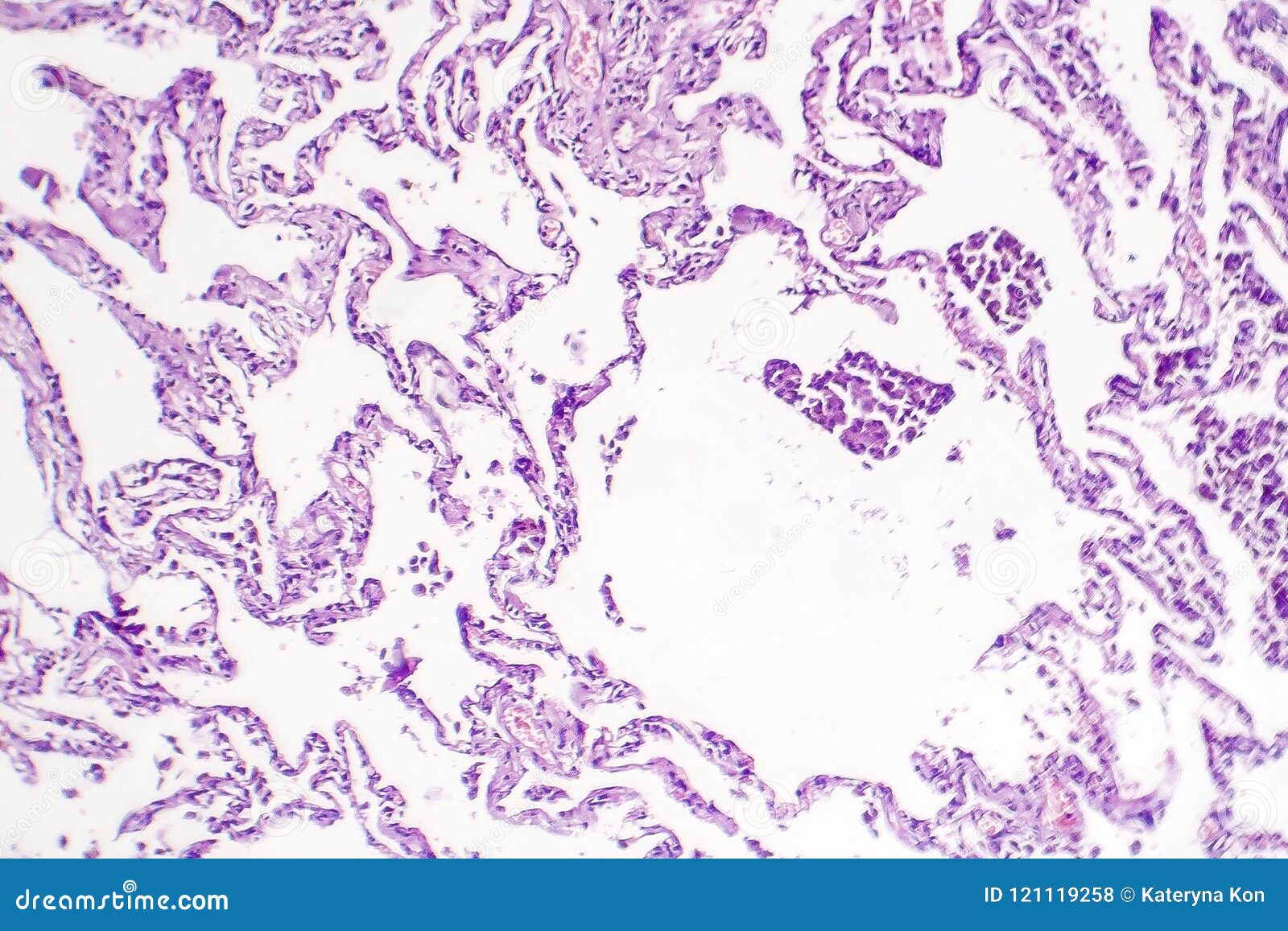 Chronic Pulmonary Congestion Stock Photo - Image of microphotograph ...