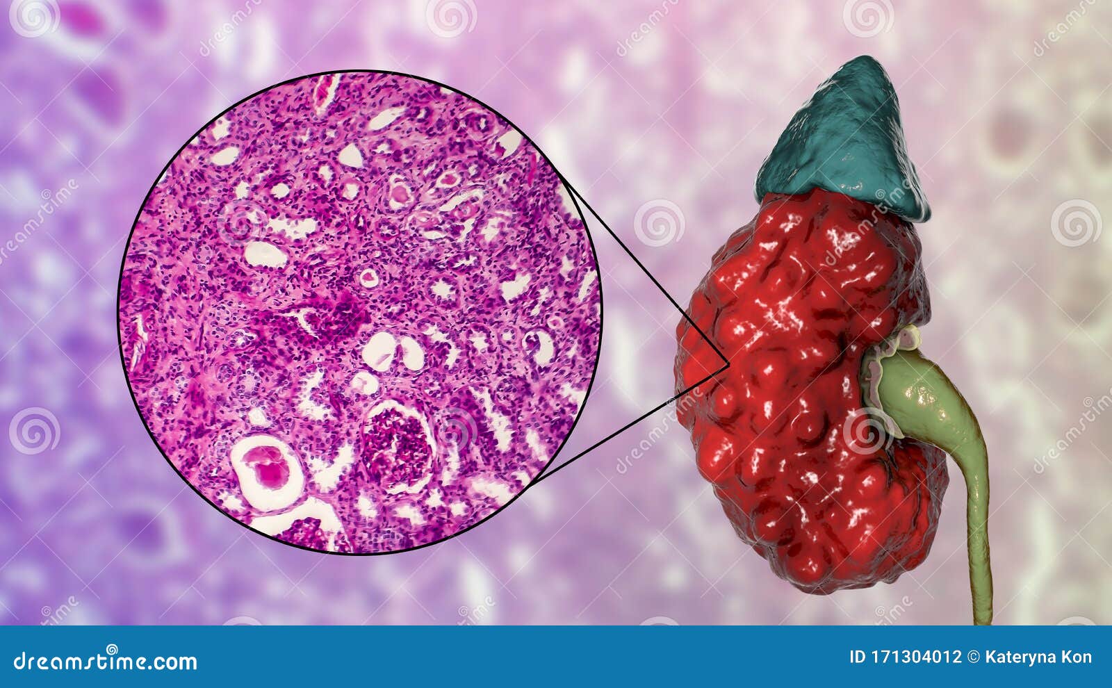 Chronic Pyelonephritis, Illustration and Light Micrograph Stock ...