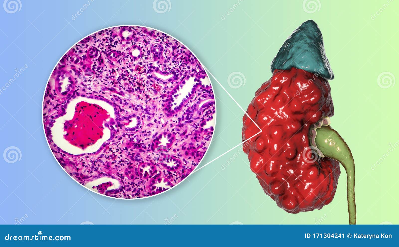 Chronic Pyelonephritis, Illustration and Light Micrograph Stock ...