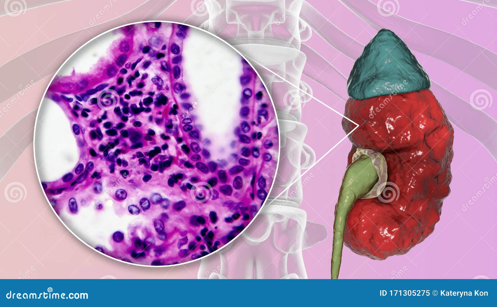 Chronic Pyelonephritis