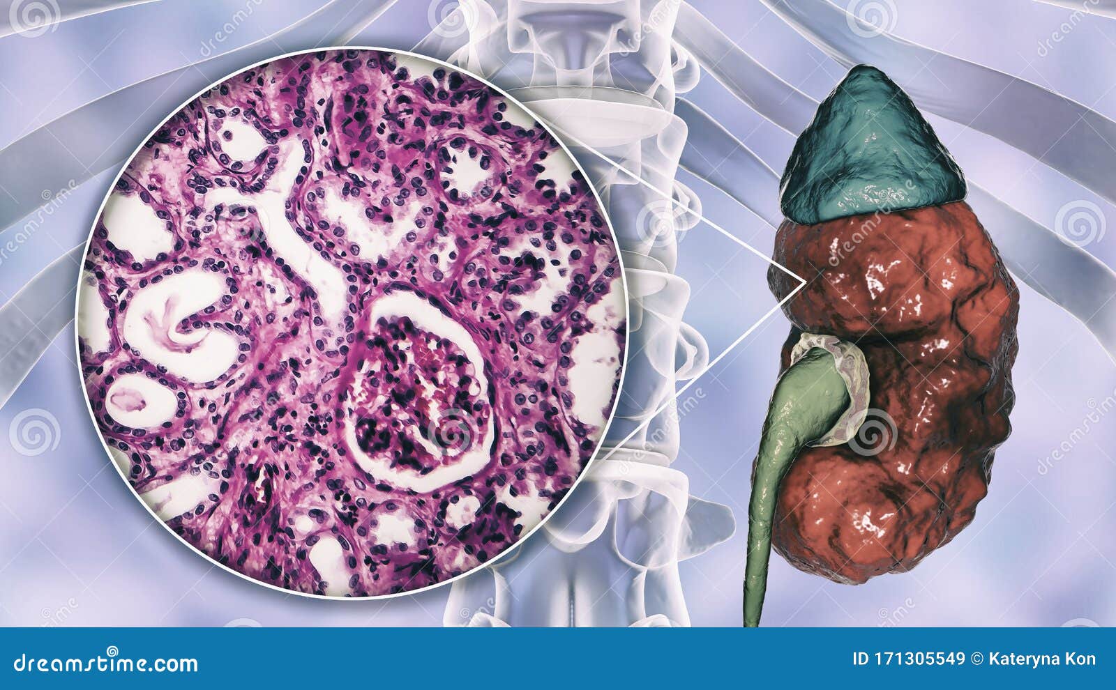 Chronic Pyelonephritis, Illustration and Light Micrograph Stock ...