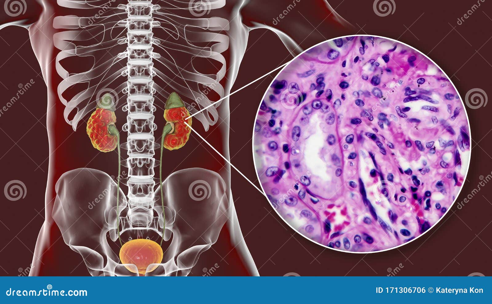 Chronic Pyelonephritis, Illustration and Light Micrograph Stock ...