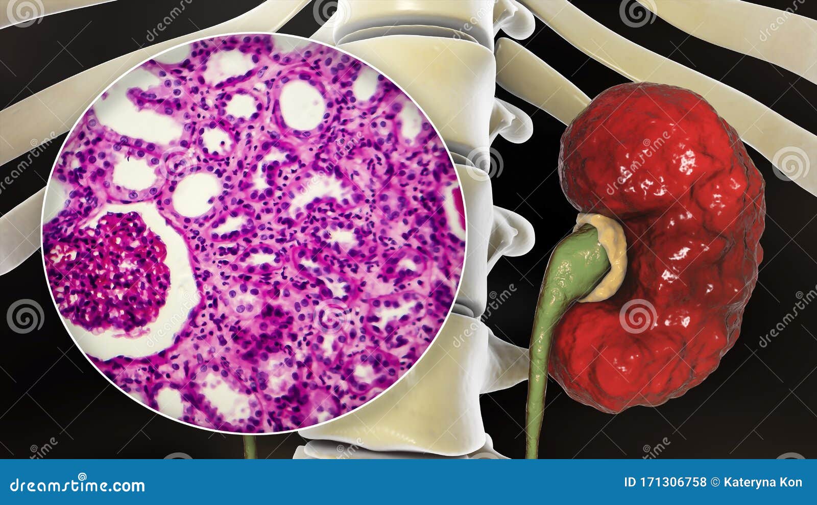 Chronic Pyelonephritis, Illustration and Light Micrograph Stock ...