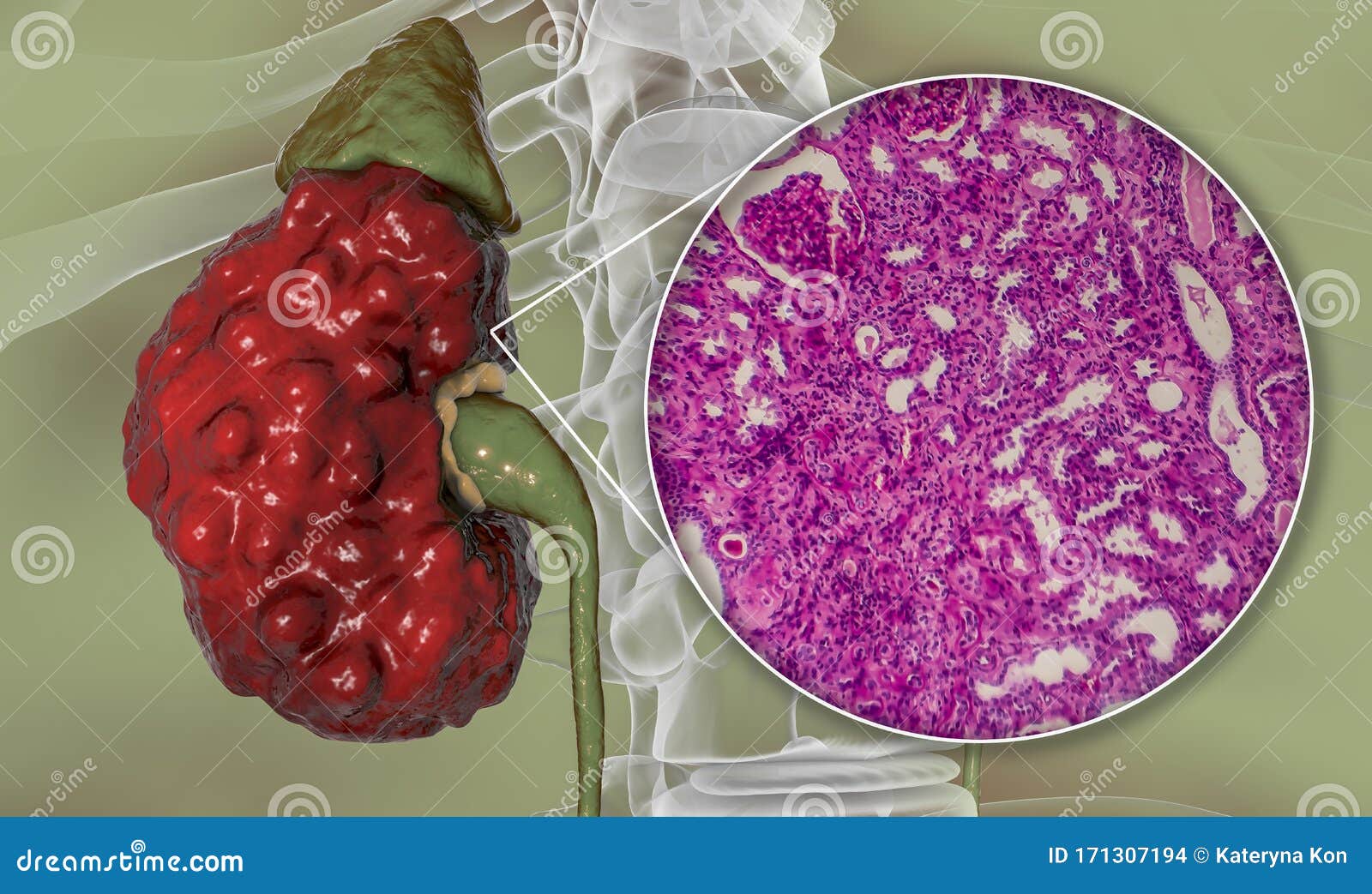 Chronic Pyelonephritis, Illustration and Light Micrograph Stock ...