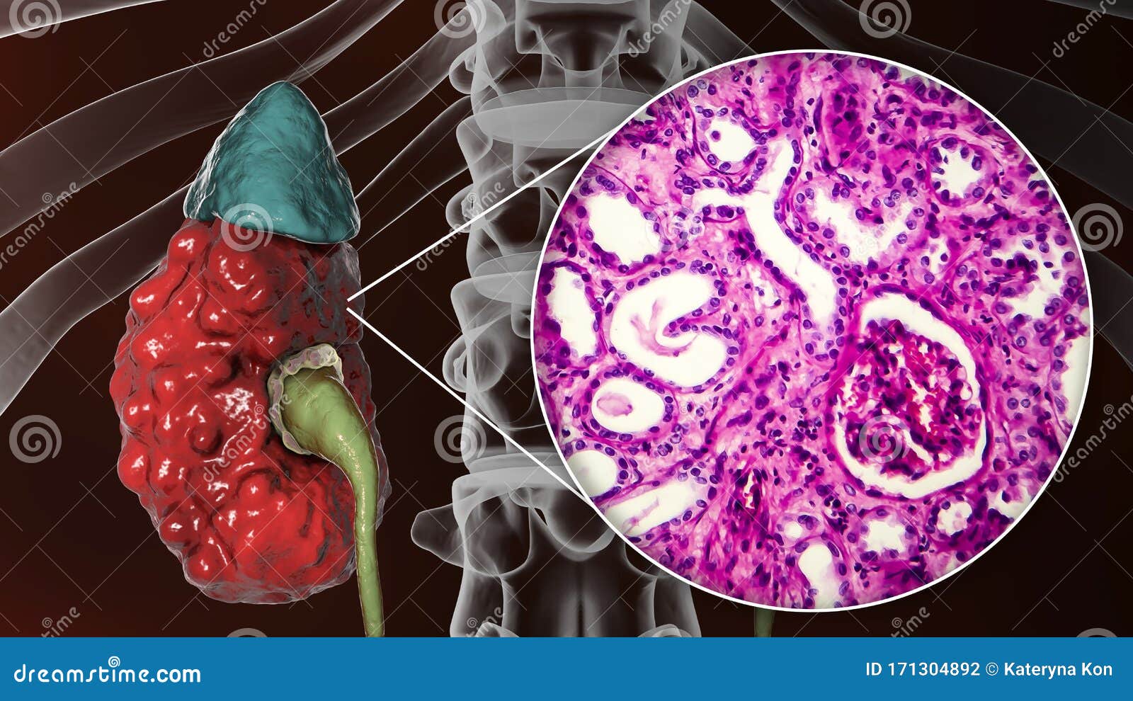 Chronic Pyelonephritis, Illustration and Light Micrograph Stock ...